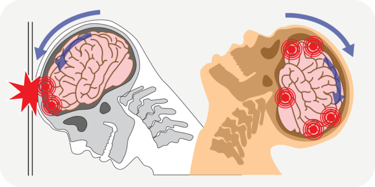 coup_countercoup_injury | 医療法人社団 越前谷脳神経クリニック